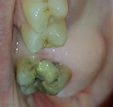 Ein Abszess im Mund mit Zahnabszess-Salbe behandeln