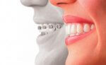 Invisalign Schienen: Alles über die durchsichtige Zahnspange