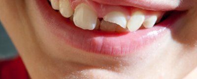 Ein abgebrochener Zahn muss schnell behandelt werden