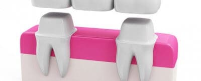 Zahnbrücke - Welche Brückenarten es gibt und was sie kosten