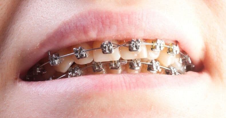 Tiefbiss: Symptome, Ursachen & Behandlungsmöglichkeiten