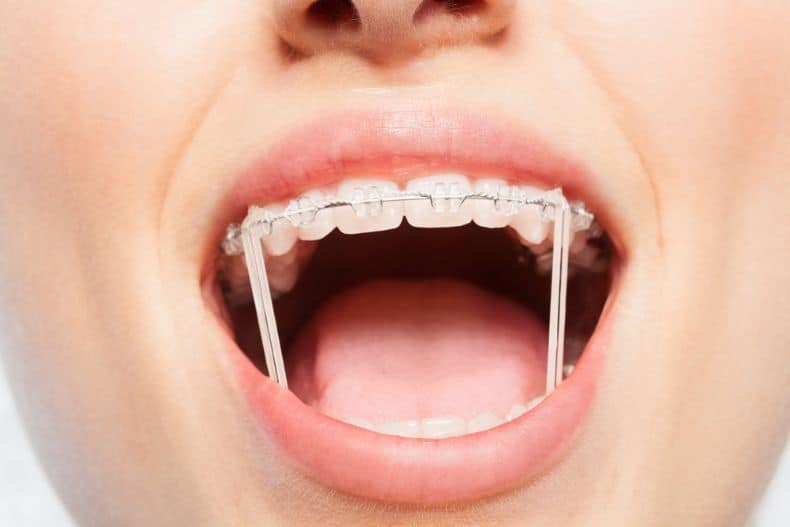 Invisalign Gummis: Wie werden die Gummizüge befestigt?