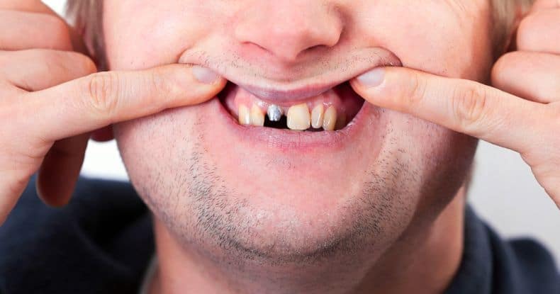 Zahn abgebrochen - Was ist zu tun? Erste Hilfe & Behandlung