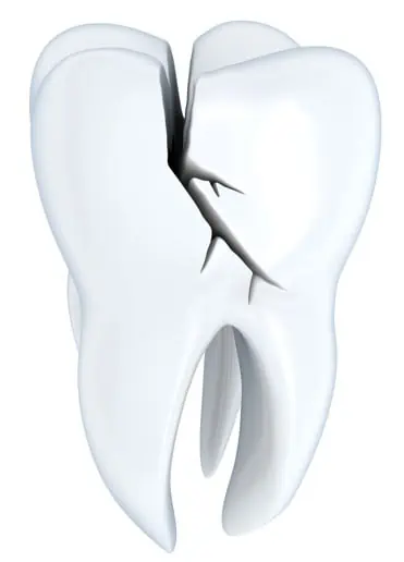 Zahn abgebrochen - Was ist zu tun? Erste Hilfe & Behandlung