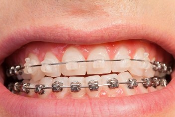 Damon Brackets Erfahrungen: Kosten & Bewertungen