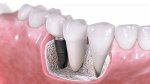 Dental Flipper: Pros and Cons of This Type of False Flipper Tooth