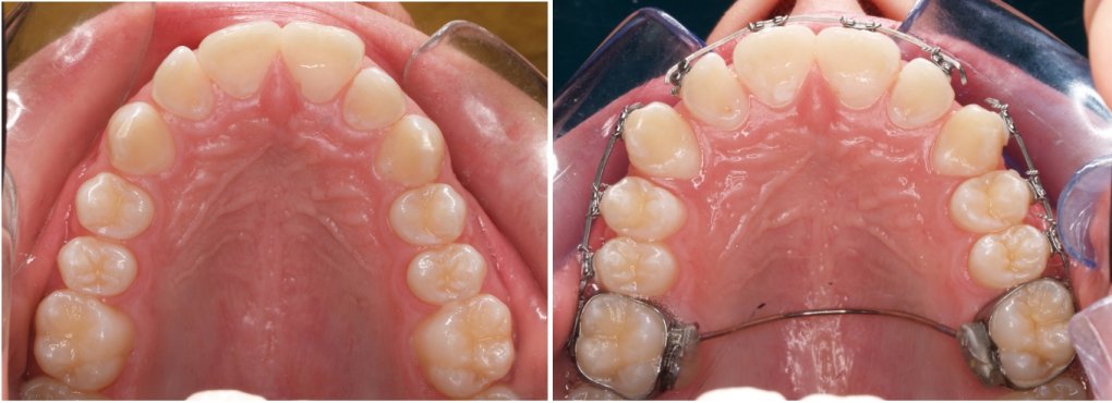 How Much Do Braces Cost in the UK? Guide to Different Types