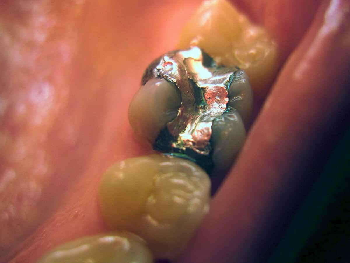 Are Amalgam Fillings Safe? White vs. Silver, Filling Removal