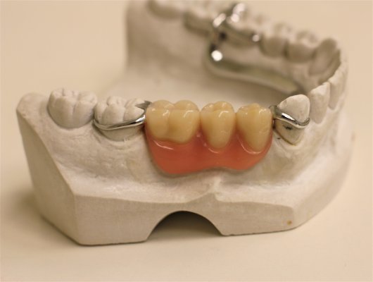 Dentures: Full and Partial, False Teeth Options & Costs UK