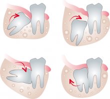 Tooth Extraction: Procedure, Costs, Healing & Pain Relief