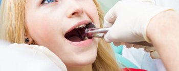 What is Dry Socket? Symptoms, Treatment & Prevention