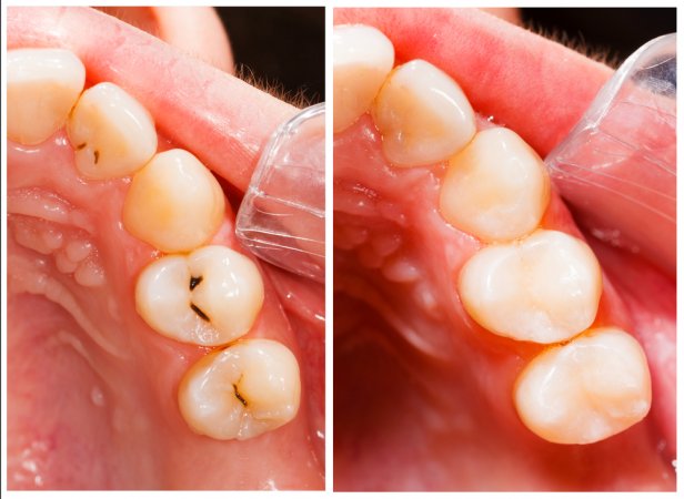 Tooth Filling Costs, Types, Procedure and What to Expect