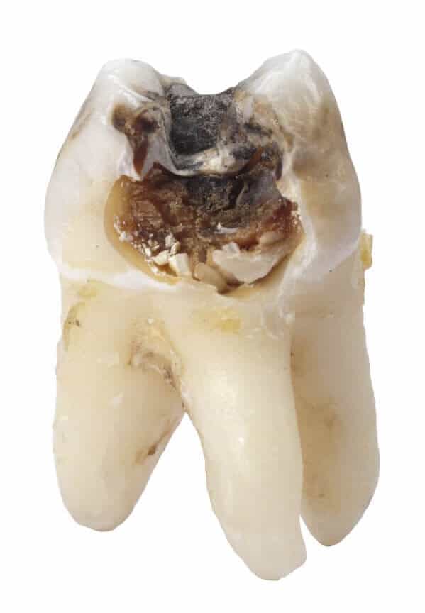 Got a Dental Cavity? Tooth Decay Symptoms, Causes, Treatment