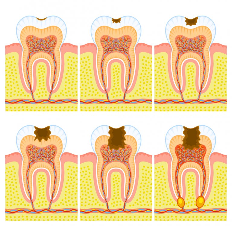 Got a Dental Cavity? Tooth Decay Symptoms, Causes, Treatment