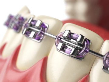 Elastic Bands for Braces: What Are They and What Do They Do?