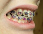 Coloured Braces: How They Work & How to Choose Your Colours