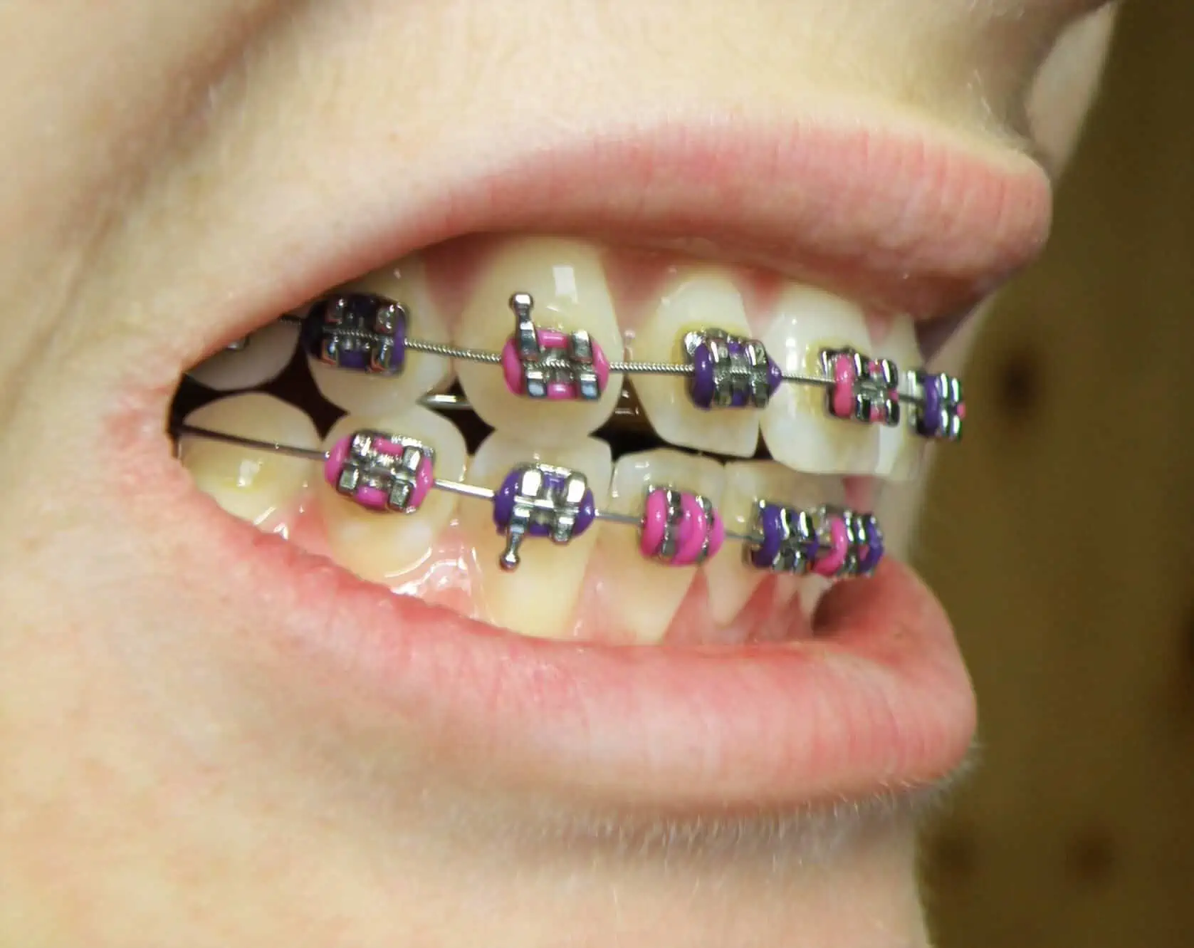 Coloured Braces: How They Work & How to Choose Your Colours