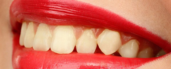 Why Are My Teeth Yellow? How to Get Rid of Yellow Stains