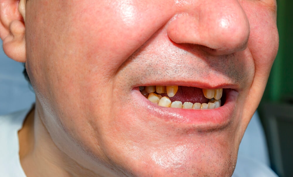 Dental Bridge Costs, Types and More (UK Tooth Bridge Guide)