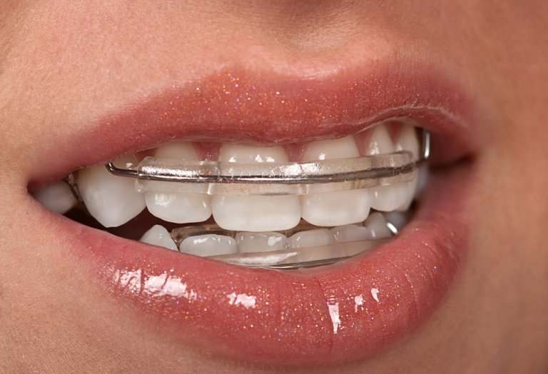 How Much Do Retainers Cost in the UK? Which Type is Best?