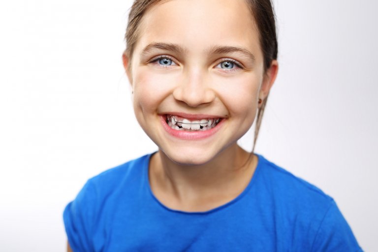 Crossbite Treatment in Adults & Kids: Braces, Surgery, Costs