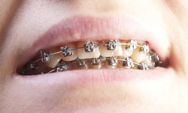 What is Overbite & How Do You Correct It: Braces or Surgery?