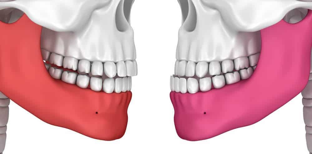 What is Overbite & How Do You Correct It: Braces or Surgery?
