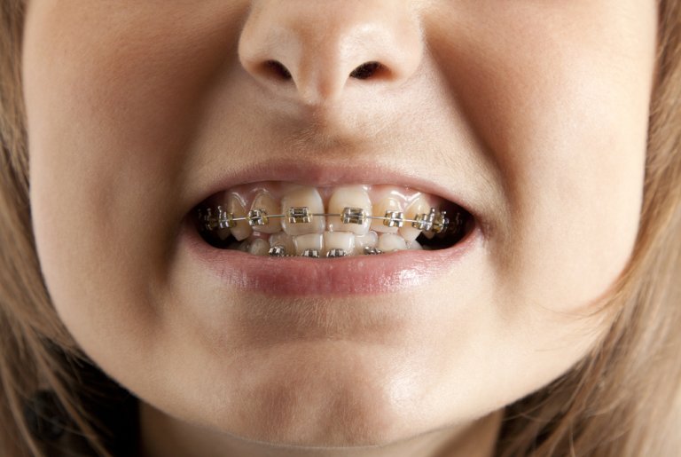 What is Underbite & How Do You Correct It: Braces? Surgery?
