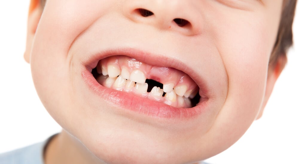 Children's Oral Health: How to Prevent Tooth Decay in Kids