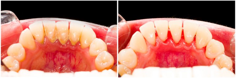 Remove Tartar from Teeth - Scale & Polish Dental Cleaning
