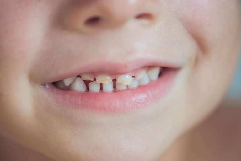 Baby Teeth Guide: What to Expect, Milk Teeth Care & Problems