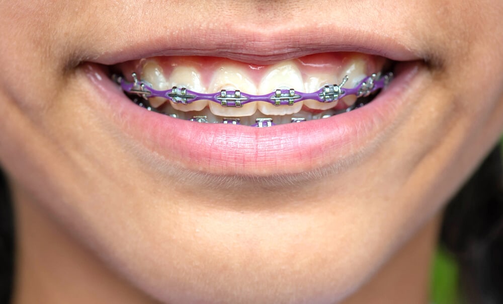 Coloured Braces: How They Work & How to Choose Your Colours