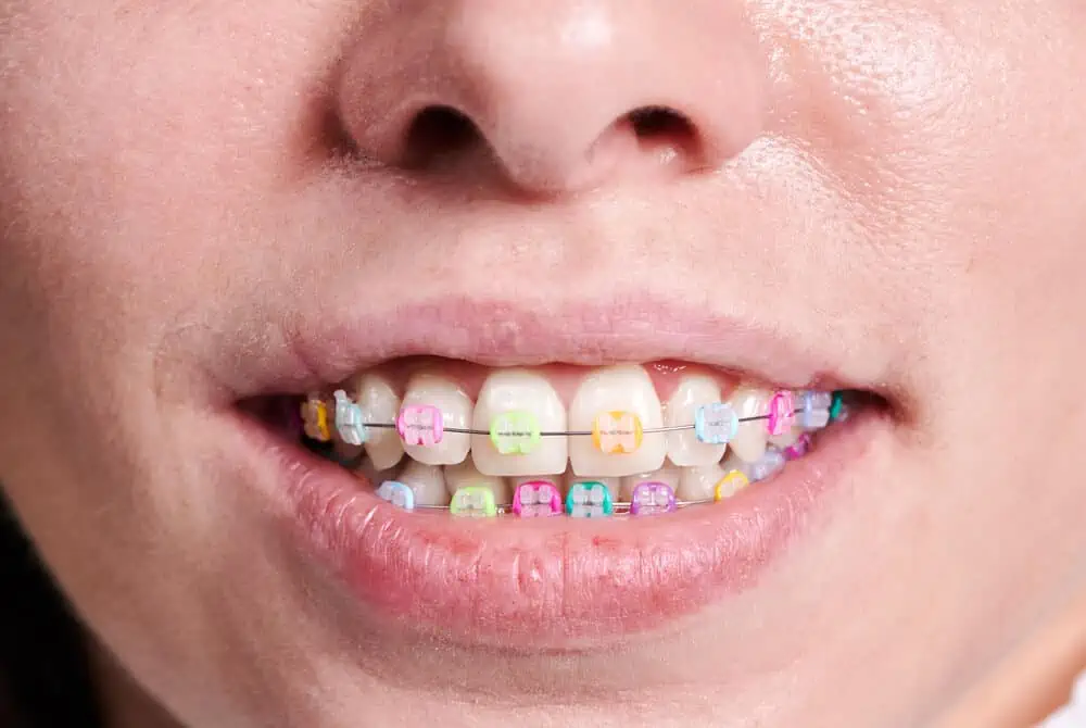 Coloured Braces: How They Work & How to Choose Your Colours