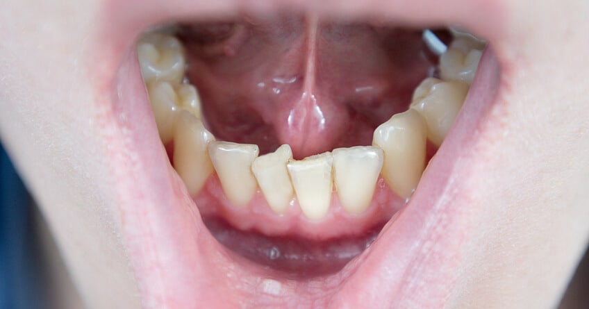 Invisalign Before and After Pictures - See Real Results