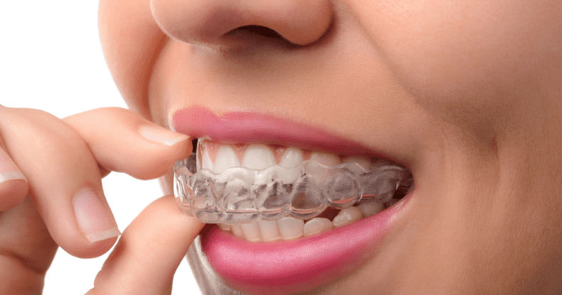Invisalign London: Find a Provider, Cost, Reviews and More