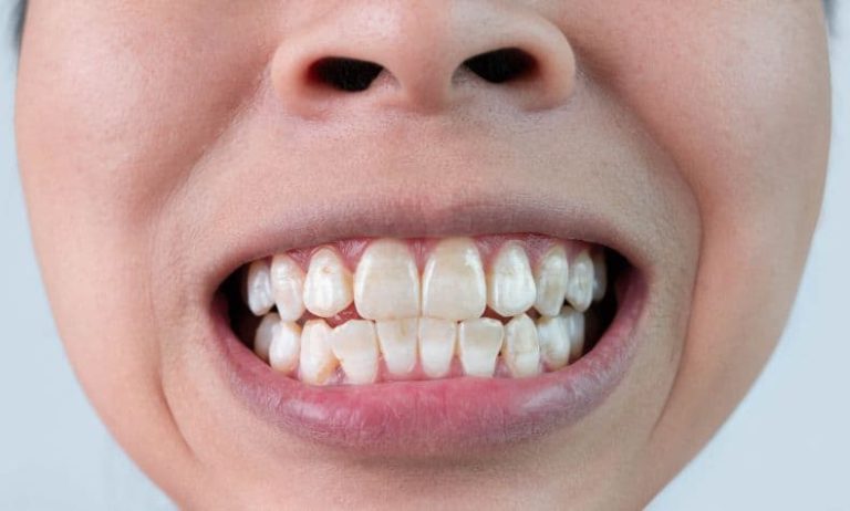 Do you have white spots on teeth? Here's how you can overcome them.