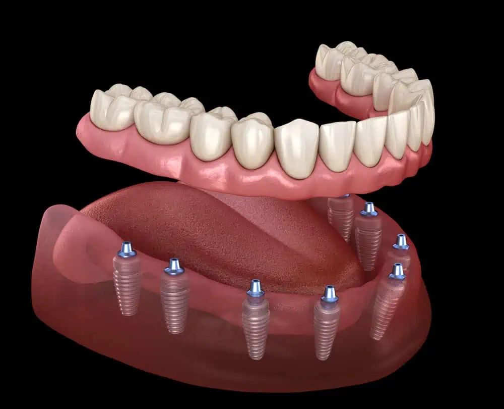All on 8 Dental Implants in Turkey: Cost, Procedure, Benefits and More