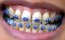 Moda en Colores de Brackets: Tendencias y Estilos Actuales [ 2024 ]