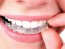 Gomas en Invisalign: qué son, para qué sirven y cómo ponérselas