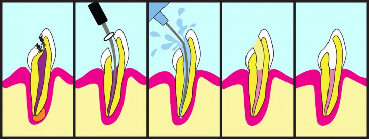 Infección de muela: guía completa tratamientos y causas