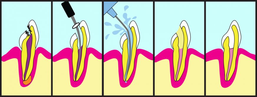 Infección de muela: guía completa tratamientos y causas