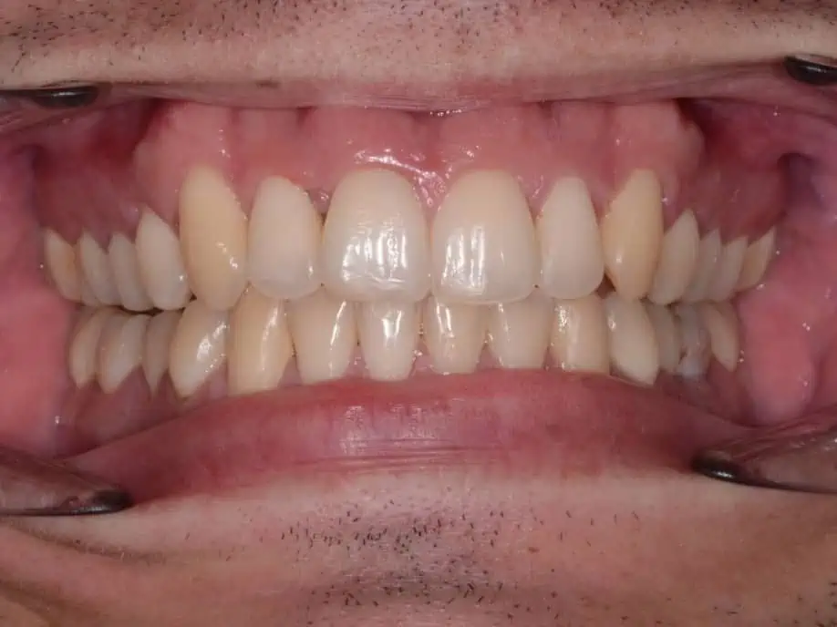 Gingivectomía y Gingivoplastia: Guía para recuperar la sonrisa