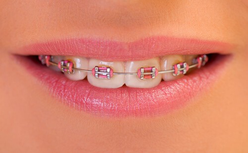 Brackets de colores: las mejores combinaciones y tendencias