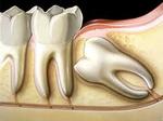 Extracción Dental: Guía completa para una recuperación rápida.