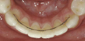 Retenedores dentales: para qué sirven, precios y tipos