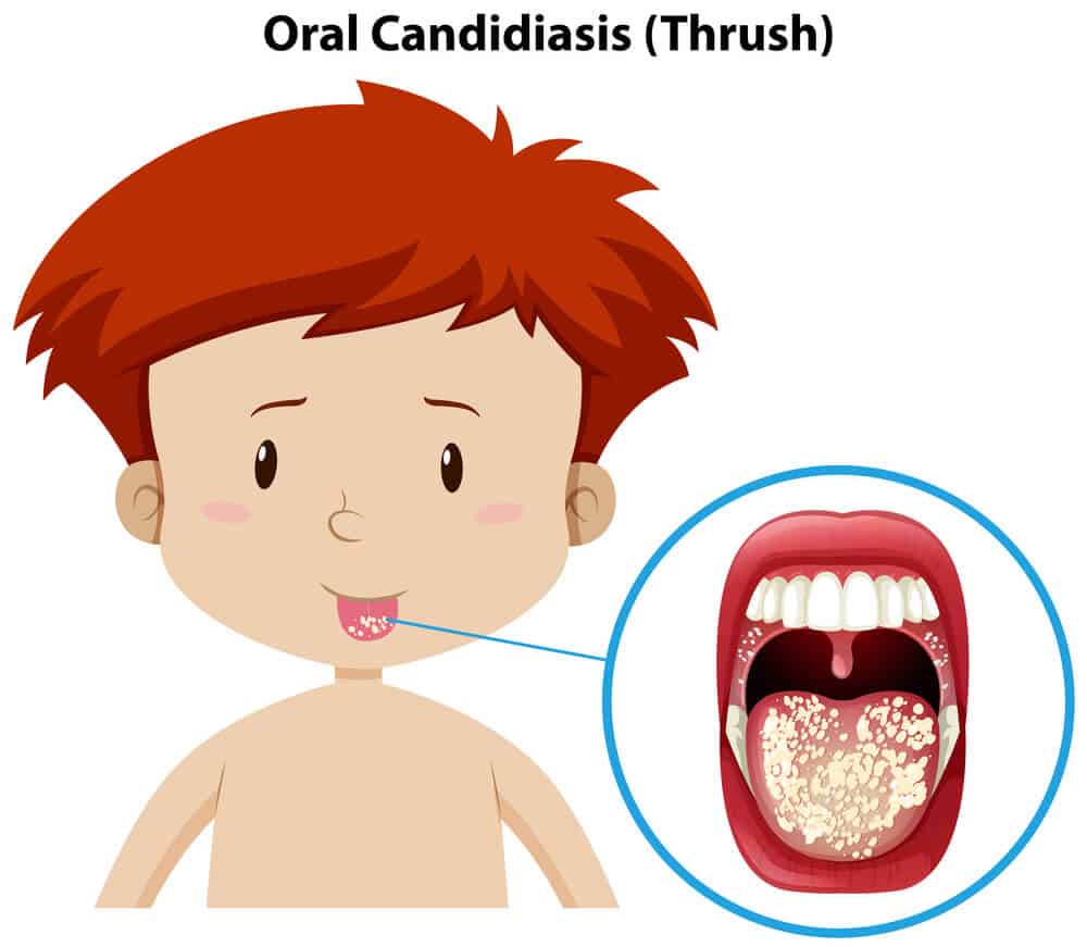 Candidiasis oral: ¿Cómo se contagia? Causas, síntomas y tratamientos