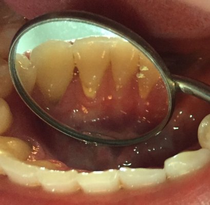 Limpieza dental profesional: el curetaje, tartrectomia y raspado