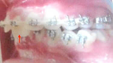 Problemas de sobremordida y tratamientos para corregirla.