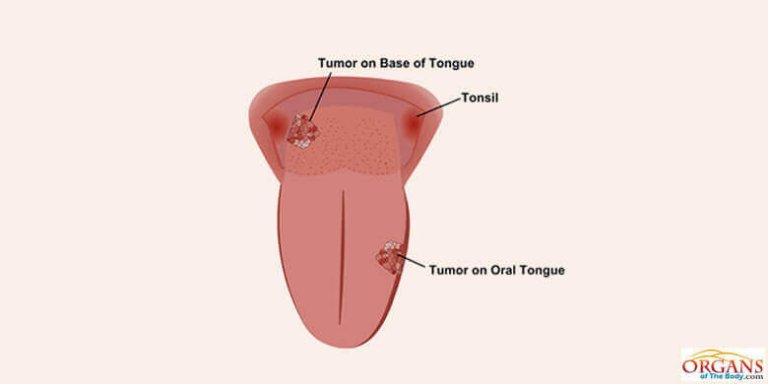 Cáncer de lengua: conoce los síntomas, causas y prevención