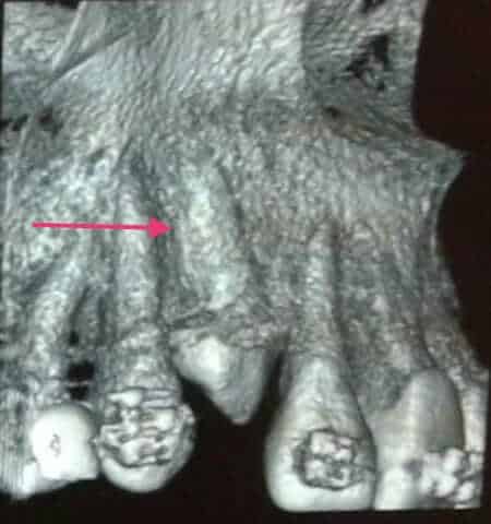 ¿Qué es la anquilosis dental y cómo debe tratarse?